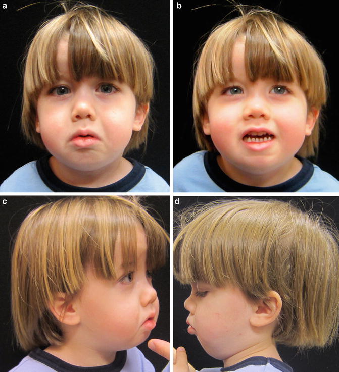 Genetics of Common Congenital Syndromes of the Head and Neck | SpringerLink