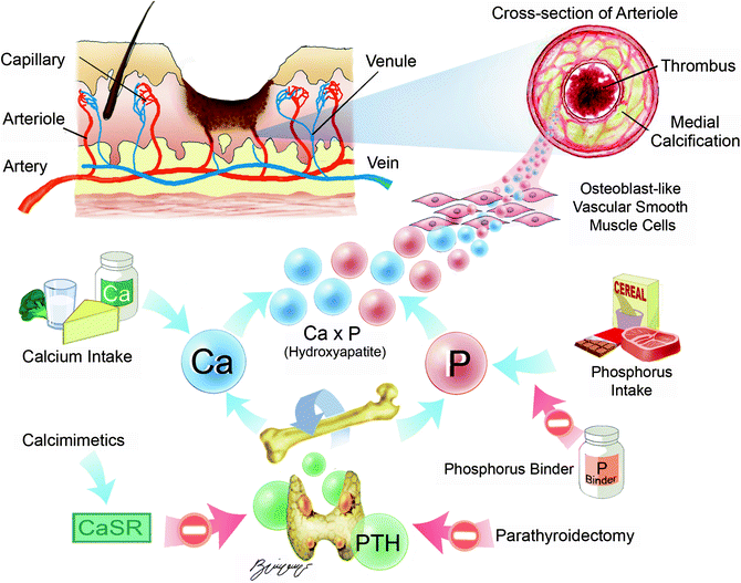Calcific Uremic Arteriolopathy (Calciphylaxis) | SpringerLink