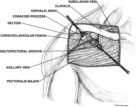 Cephalic Arch Stenosis | SpringerLink