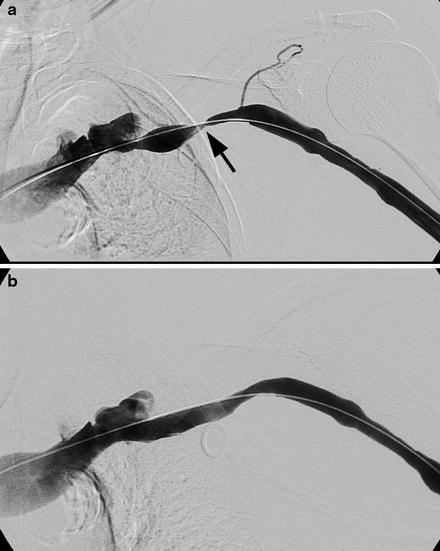 Cephalic Arch Stenosis | SpringerLink