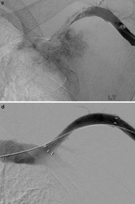 Cephalic Arch Stenosis | SpringerLink