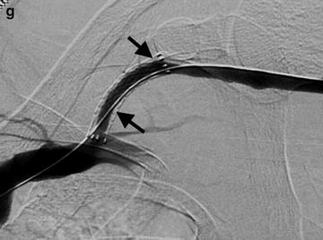 Cephalic Arch Stenosis | SpringerLink