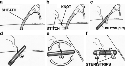 Puncture Site Management | SpringerLink