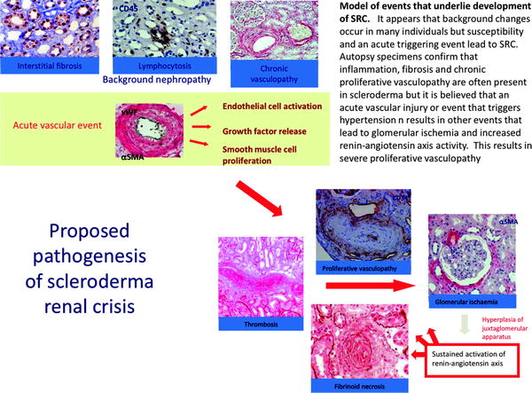 Scleroderma Renal Crisis | SpringerLink