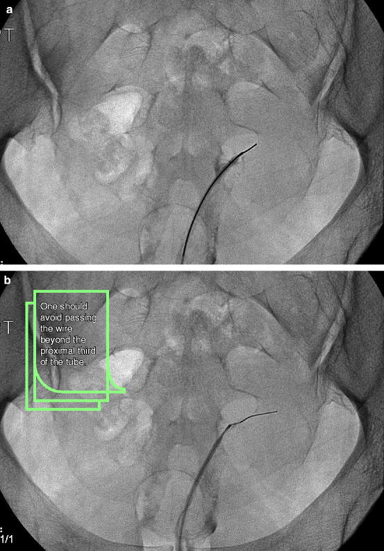 Fallopian Tube Recanalization | SpringerLink