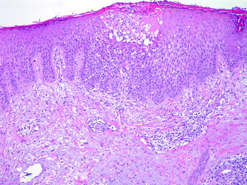 Intraepidermal Blisters | SpringerLink