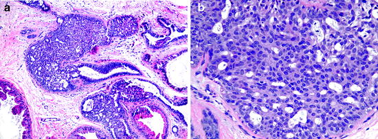 Risk Lesions of the Breast: Usual Ductal Hyperplasia, Atypical Ductal ...