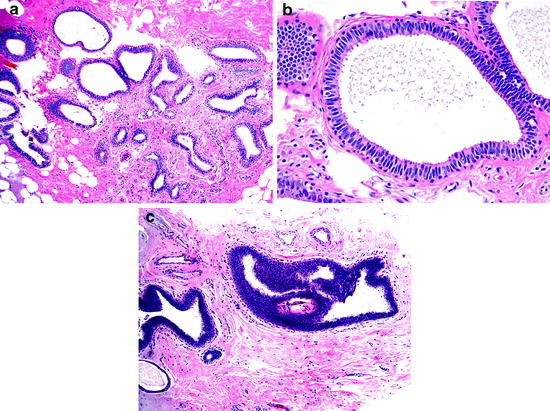 Risk Lesions of the Breast: Usual Ductal Hyperplasia, Atypical Ductal ...