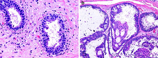 Risk Lesions of the Breast: Usual Ductal Hyperplasia, Atypical Ductal ...