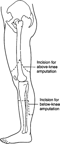 Mangled Extremities and Amputations | SpringerLink
