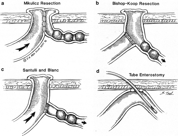 Meconium Ileus | SpringerLink