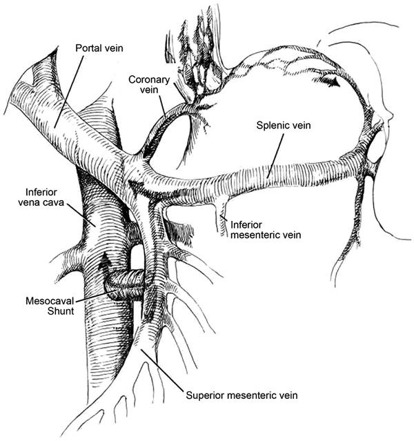 Portal Hypertension | SpringerLink