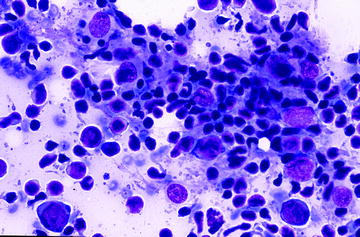 The Polymorphous Lymphoid Cell Pattern | SpringerLink