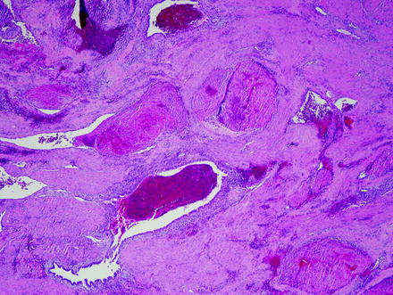 Postpartum Hemorrhage, Subinvolution of the Placental Site, and ...