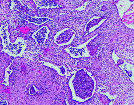 Postpartum Hemorrhage, Subinvolution of the Placental Site, and ...