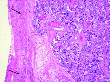 Postpartum Hemorrhage, Subinvolution of the Placental Site, and ...