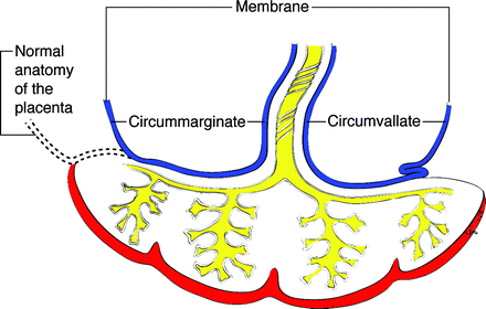 Placental Shape Aberrations | SpringerLink
