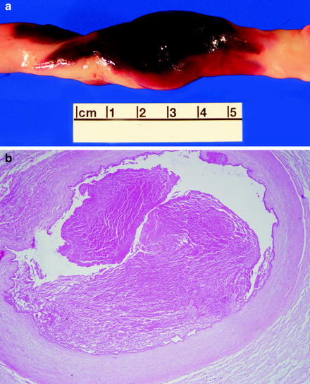 Pathology of the Umbilical Cord | SpringerLink