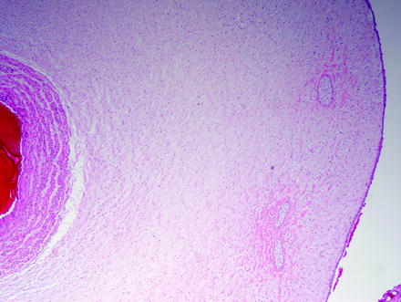 Pathology of the Umbilical Cord | SpringerLink