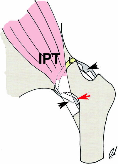 Iliopsoas Tendon Release | SpringerLink