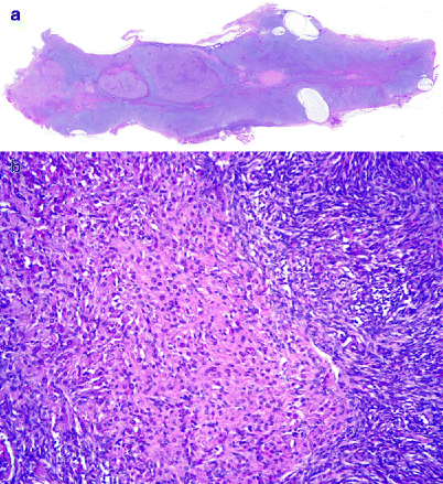 Sex Cord Stromal Tumors of the Ovary | SpringerLink