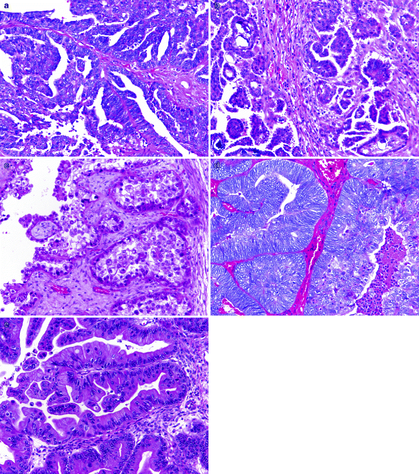 Surface Epithelial Tumors: Pathology Introduction | SpringerLink