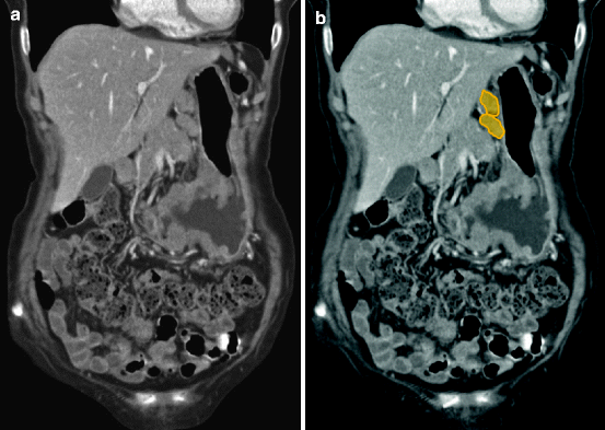 Abdominal Lymph Node Anatomy | SpringerLink