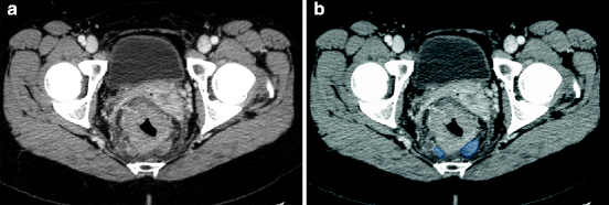 Abdominal Lymph Node Anatomy | SpringerLink