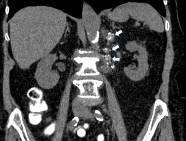 Abdominal Lymph Node Anatomy | SpringerLink