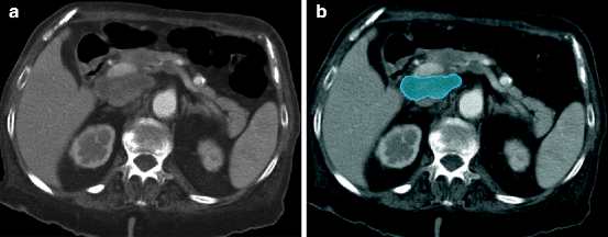 Abdominal Lymph Node Anatomy | SpringerLink