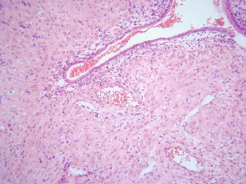 Benign Endocervical Glandular Lesions | SpringerLink