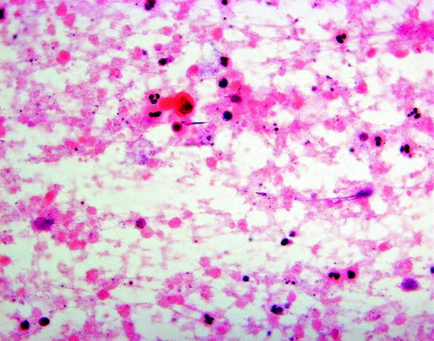 Serous Fluids | SpringerLink