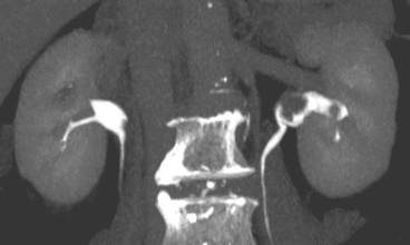 How to Do a CT Urogram (CTU) | SpringerLink