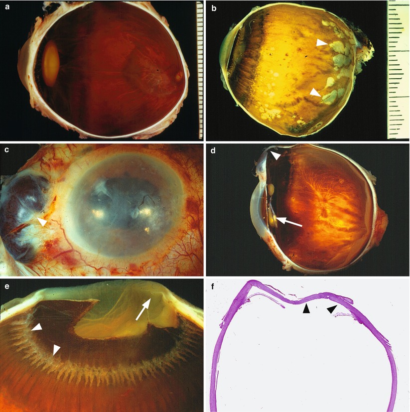 Absolute Glaucoma | SpringerLink