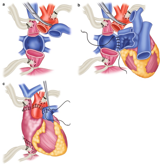 Surgical Treatment of Advanced Heart Failure | SpringerLink