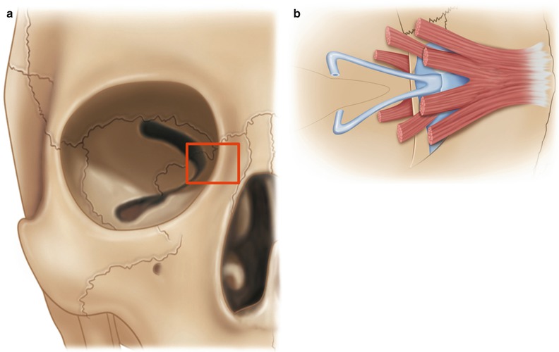 Nasoethmoid (Naso-Orbital-Ethmoid): NOE Fractures | SpringerLink