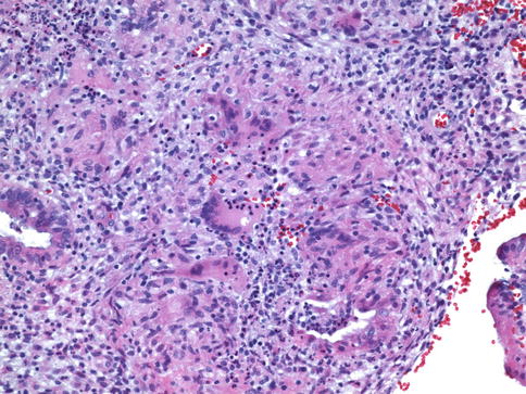 Pathology of the Fallopian Tube | SpringerLink