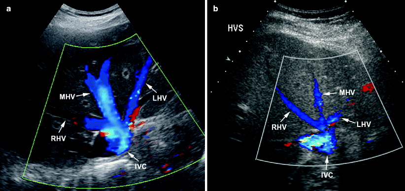 Ultrasound of the Hepatoportal Circulation | SpringerLink