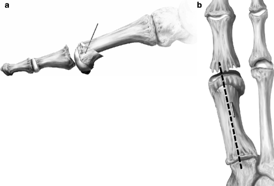 Hallux Rigidus: Distal First Metatarsal Osteotomy/Hohmann Procedure ...