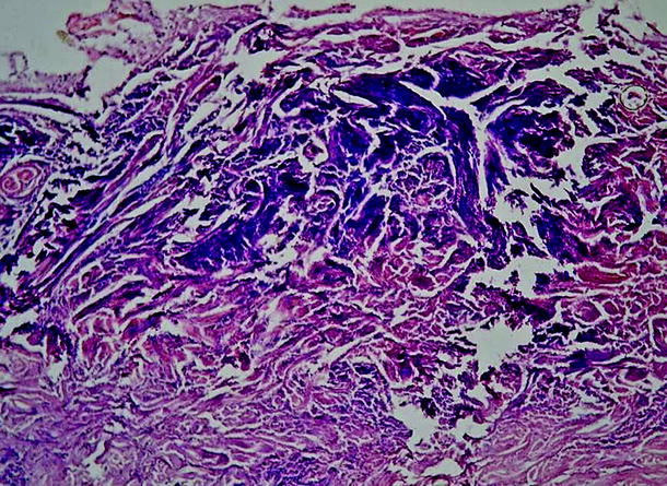 Acral Necrosis in a Heavy Smoker | SpringerLink