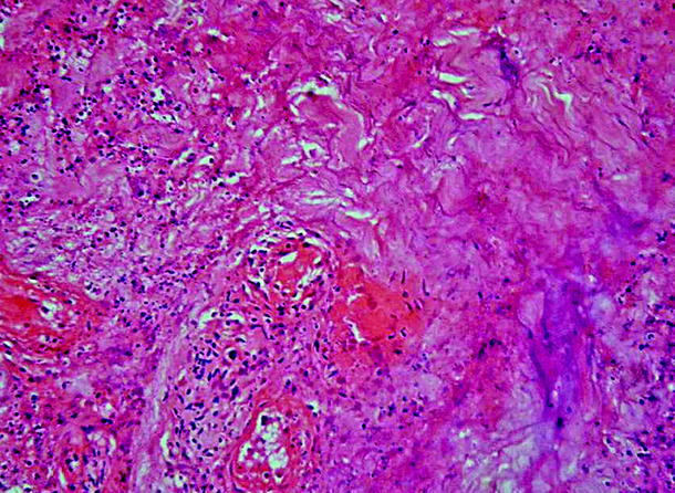 Acral Necrosis in a Heavy Smoker | SpringerLink