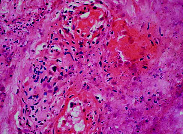 Acral Necrosis in a Heavy Smoker | SpringerLink