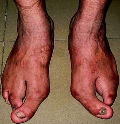 Cleft Palate, with a Peculiar Limb Deformity | SpringerLink