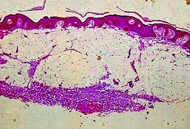 Atrophic Blaschkoid Lines Associated with Syndactyly | SpringerLink