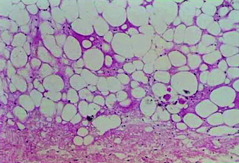 Photosensitivity, Lipodystrophy, Mental Retardation and Joint ...