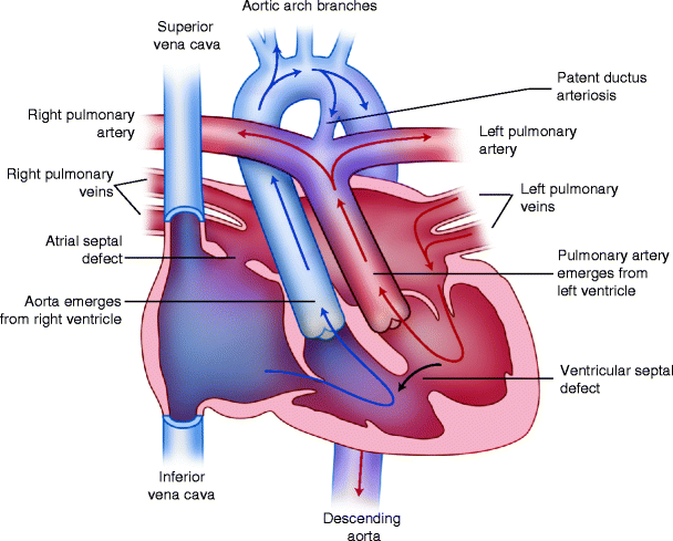 Transposition of Great Arteries | SpringerLink
