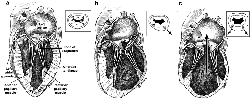 Mitral Valve Anatomy and Current Surgical and Percutaneous Approaches ...