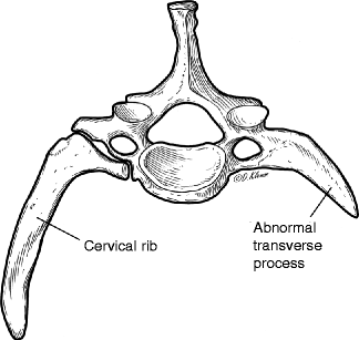 Congenital Abnormalities, Cervical Ribs, and Related Bony Abnormalities ...