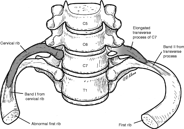 Congenital Abnormalities, Cervical Ribs, and Related Bony Abnormalities ...