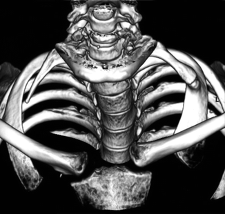 Congenital Abnormalities, Cervical Ribs, and Related Bony Abnormalities ...